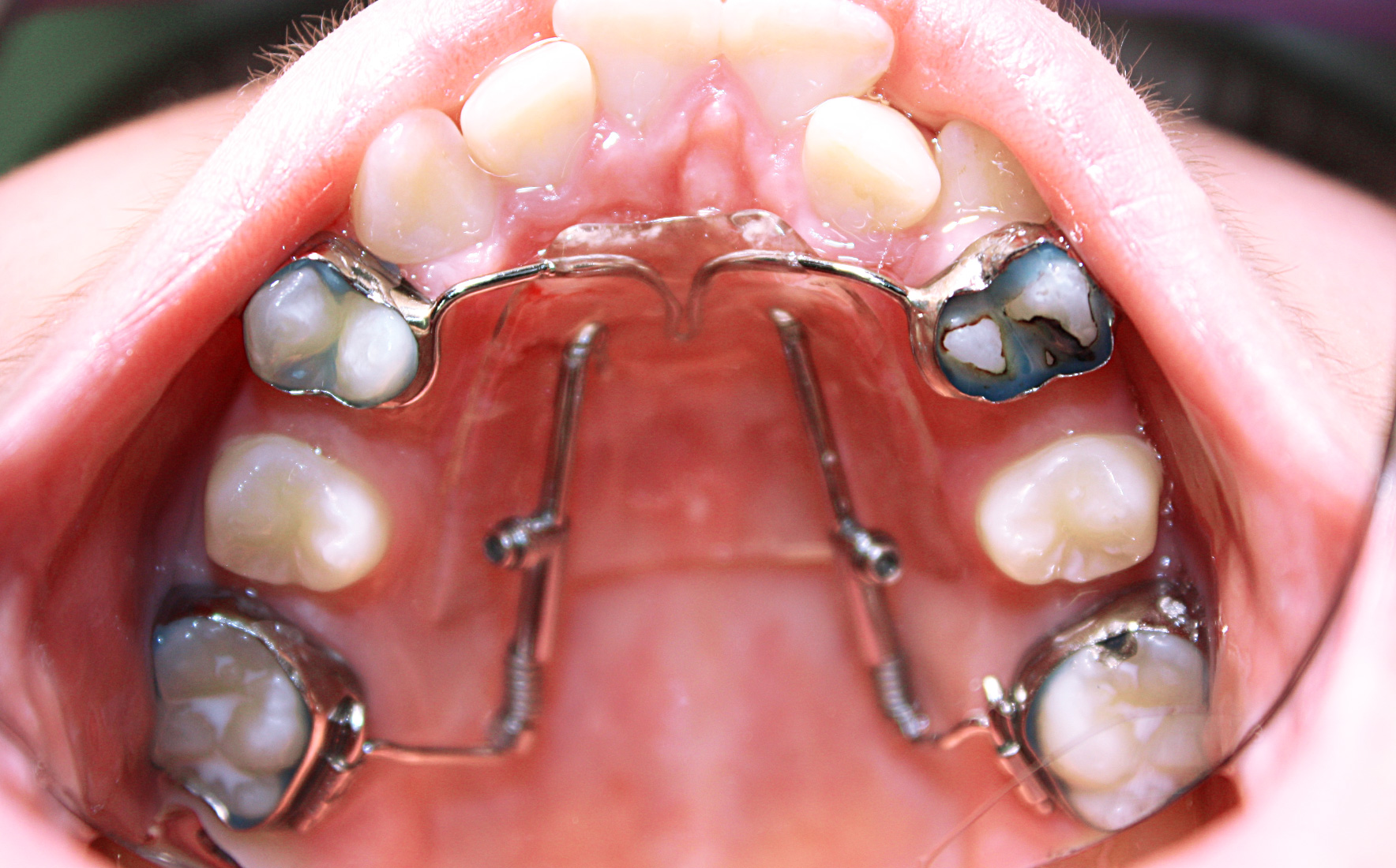 Der Distaljet eignet sich sehr gut für eine Erwachsenenbehandlung